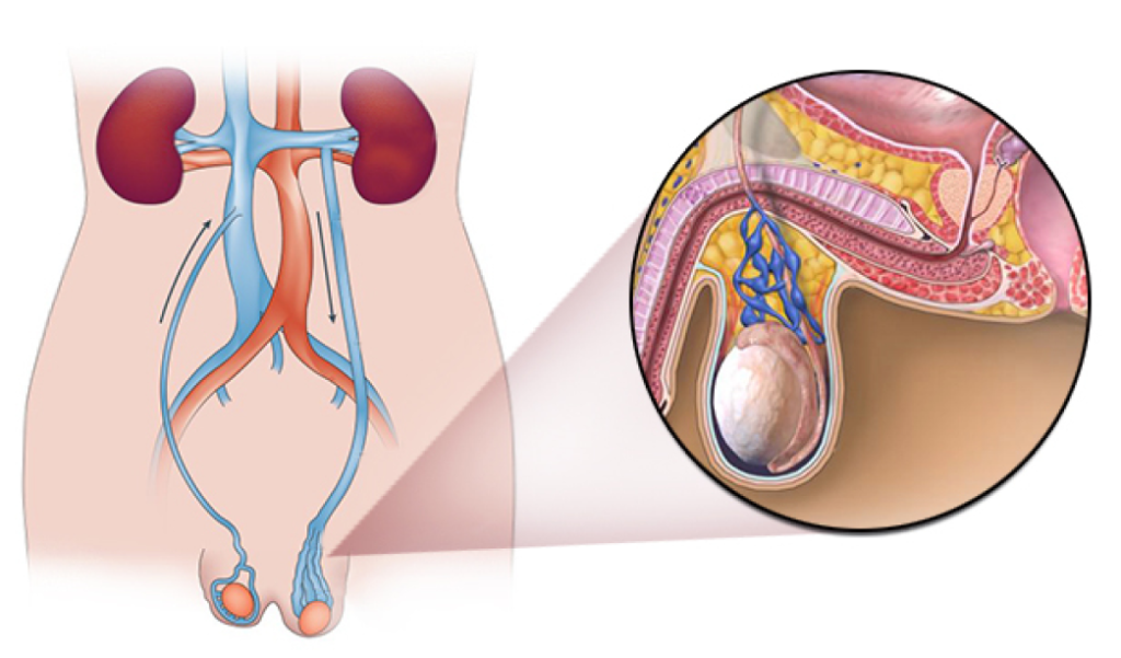 Varicocelectomy Surgery Dr Aloy J Mukherjee