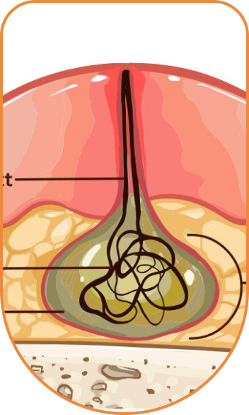 Surgeries for Pilonidal Sinus – Dr. Aloy J Mukherjee